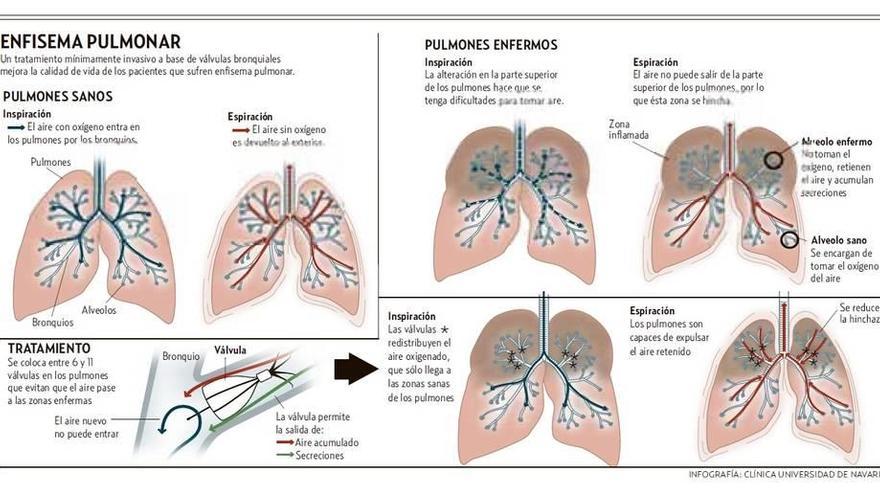 Se implantan por primera vez en el Estado "muelles" para el enfisema ...
