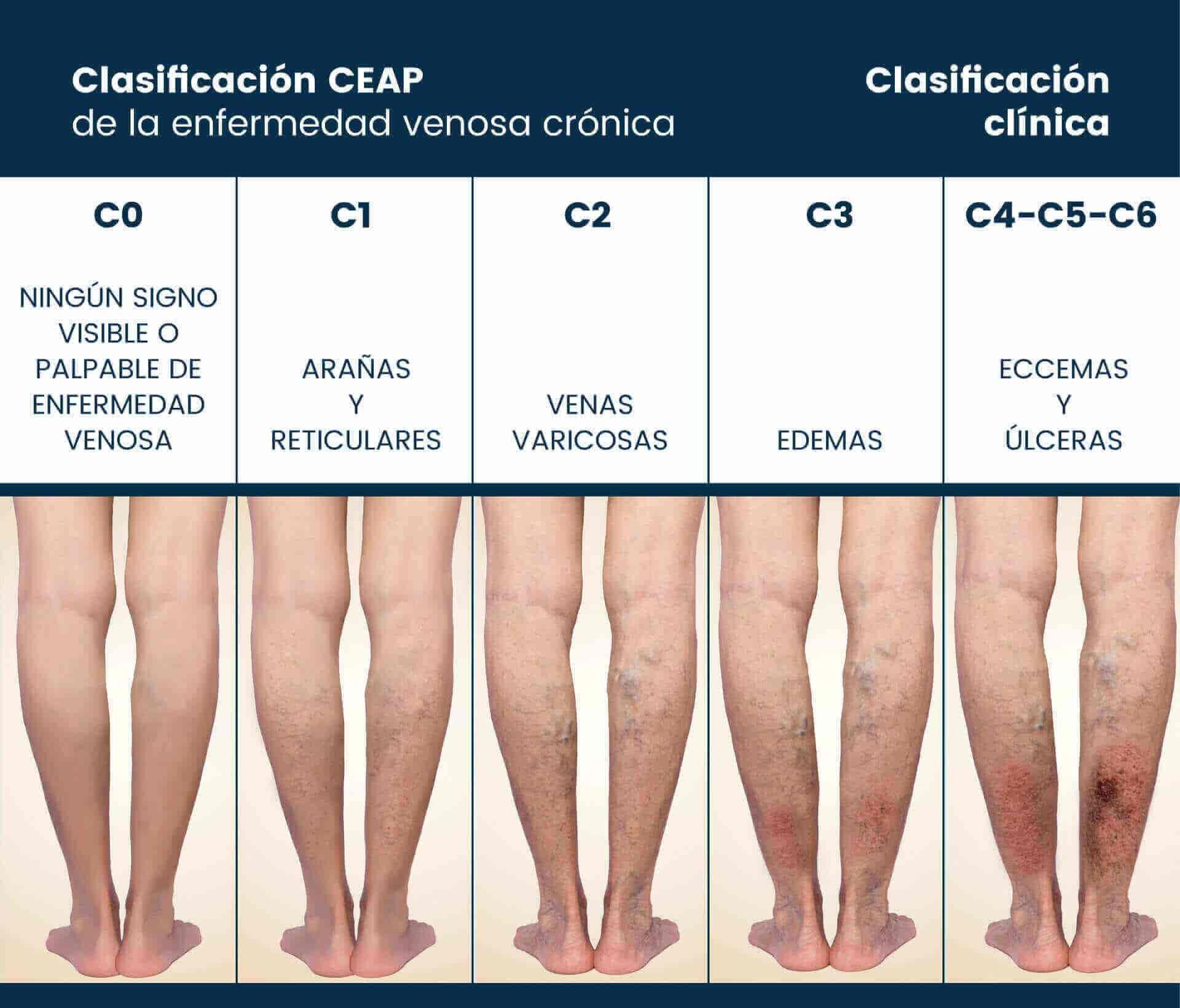 Detectar las varices a tiempo, clave para frenar su avance